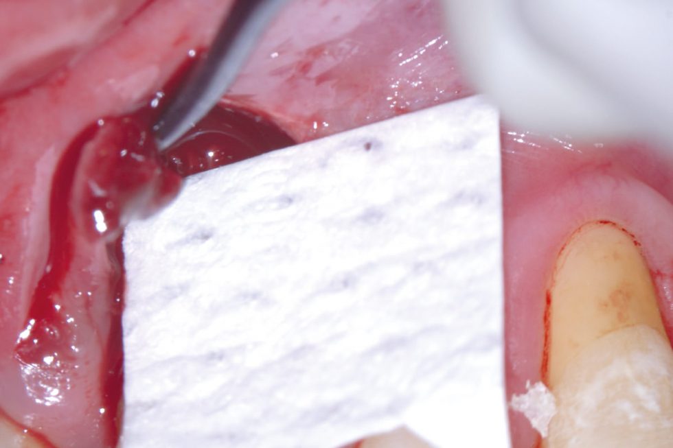 Botiss collprotect přírodní kolagenová membrána | Botiss | biomateriály