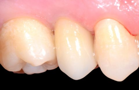 Botiss collacone max flexibilní kužel | Botiss | biomateriály